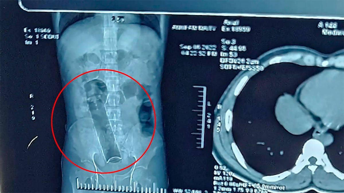 Joven debió ser operado de urgencia: tuvo un desodorante en el ano ...